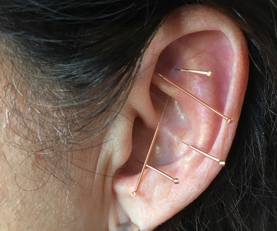 Acudetox Auricular Therapy – Absolute Ozone